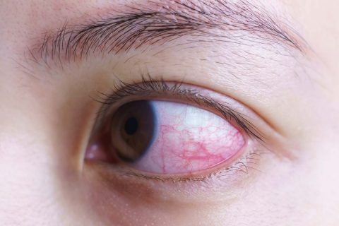 Keratitis | Lifepack.id