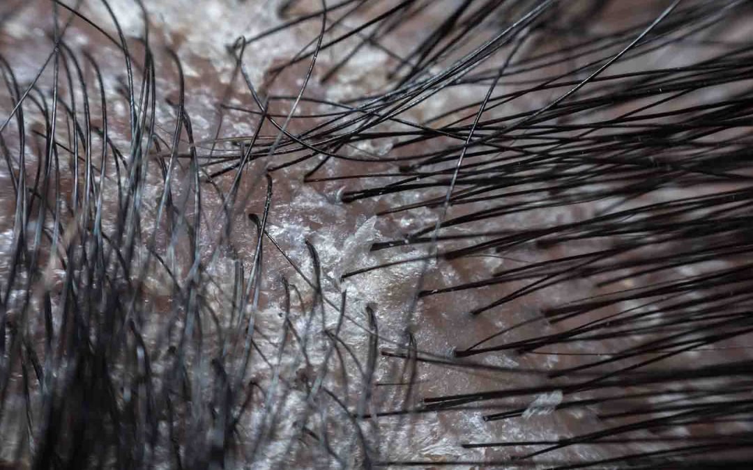 Dermatitis Seboroik: Gejala, Penyebab, dan Cara Mengobati | Lifepack.id