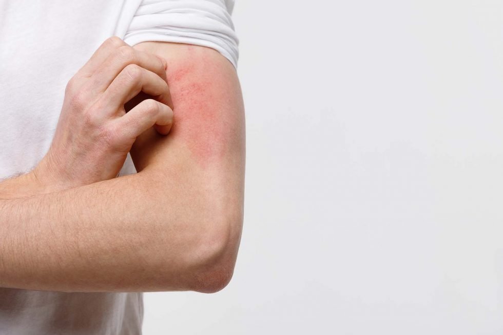 Mengenal Berbagai Obat Scabies dan Cara Kerjanya | Lifepack.id